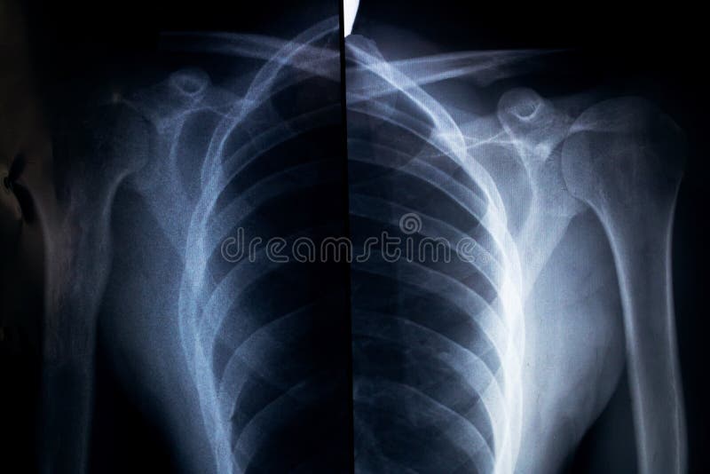 Scapula Anatomy Xray