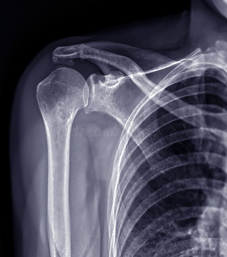 X-ray Shoulder Joint Shoulder Transaxillary View for Diagnosis Fracture ...