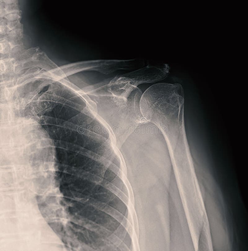 X-ray Shoulder Joint Shoulder Transaxillary View for Diagnosis Fracture ...