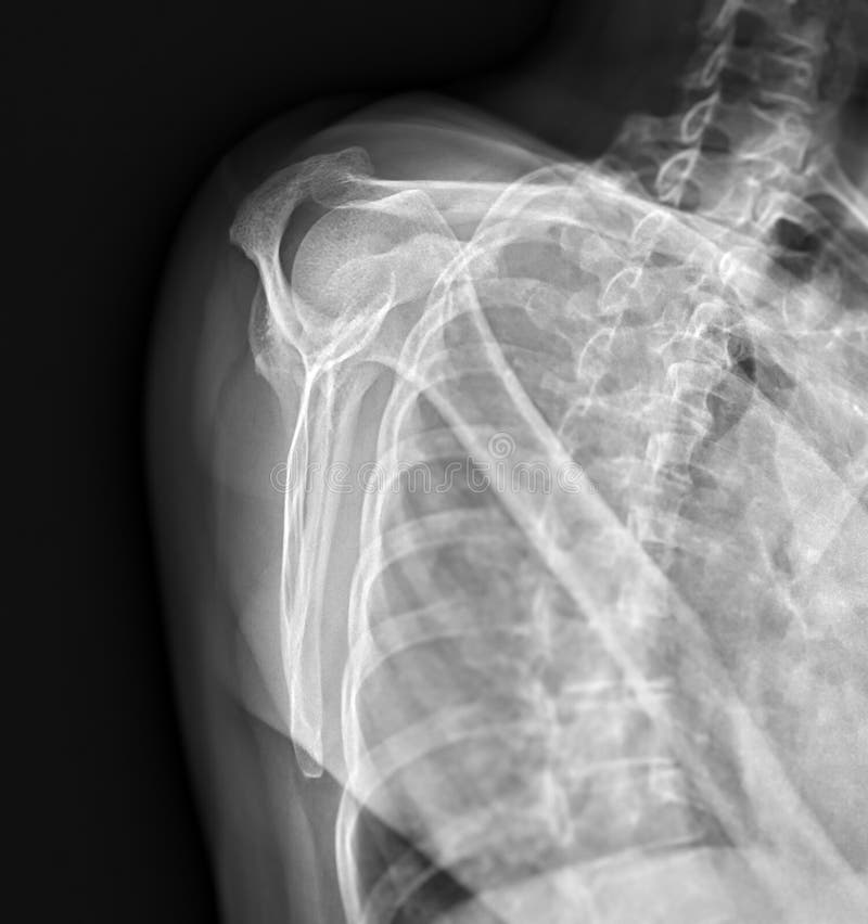 Shoulder Transcapular Y View Xray Image Stock Photo - Image of shoulder ...