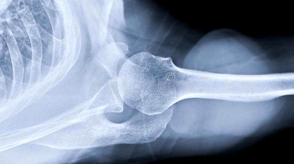 X-ray Shoulder Joint Shoulder Transaxillary View for Diagnosis Fracture ...
