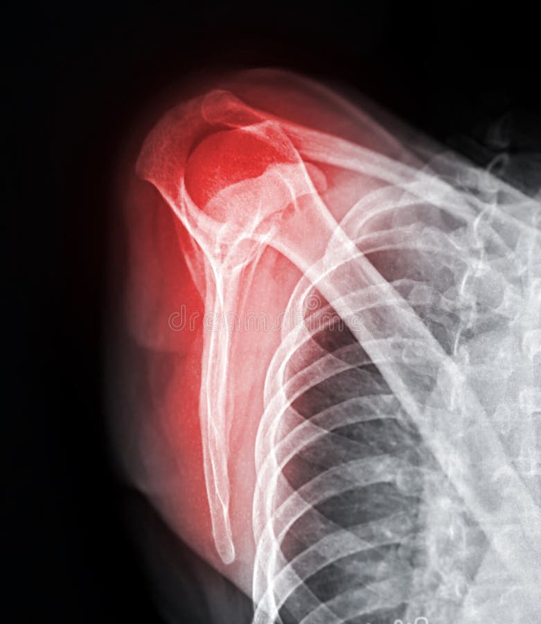 Shoulder Transcapular Y View Xray Image Stock Photo - Image of shoulder ...