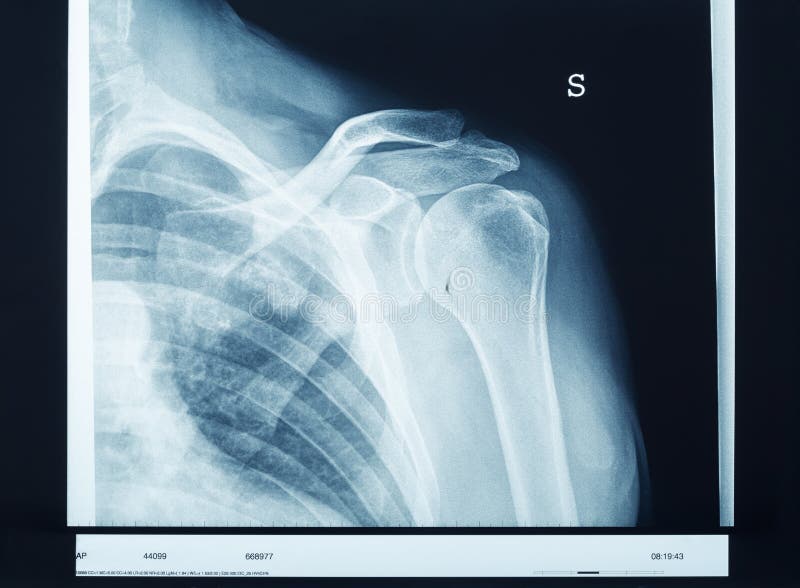 X-ray shoulder stock image. Image of shoulder, care, bone - 45652861
