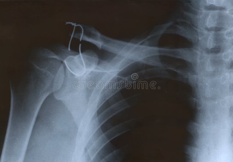 X-ray of Shoulder with Wire Stock Photo - Image of blade, spine: 11726148