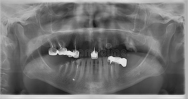 X-ray Showing Dental Structure and Missing Teeth in the Lower Jaw Stock ...
