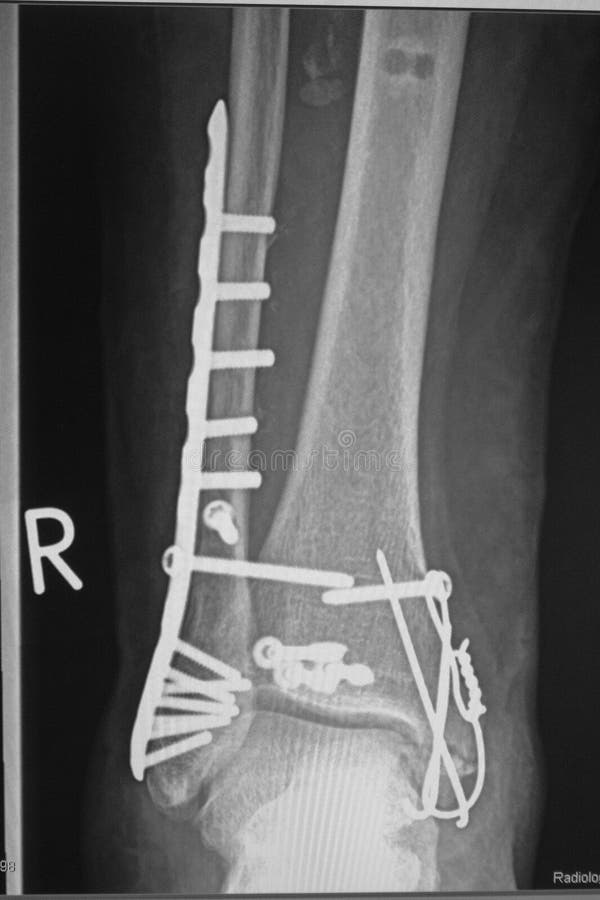 An X-ray Shows an Ankle Fracture after Surgery Stock Image - Image of ...