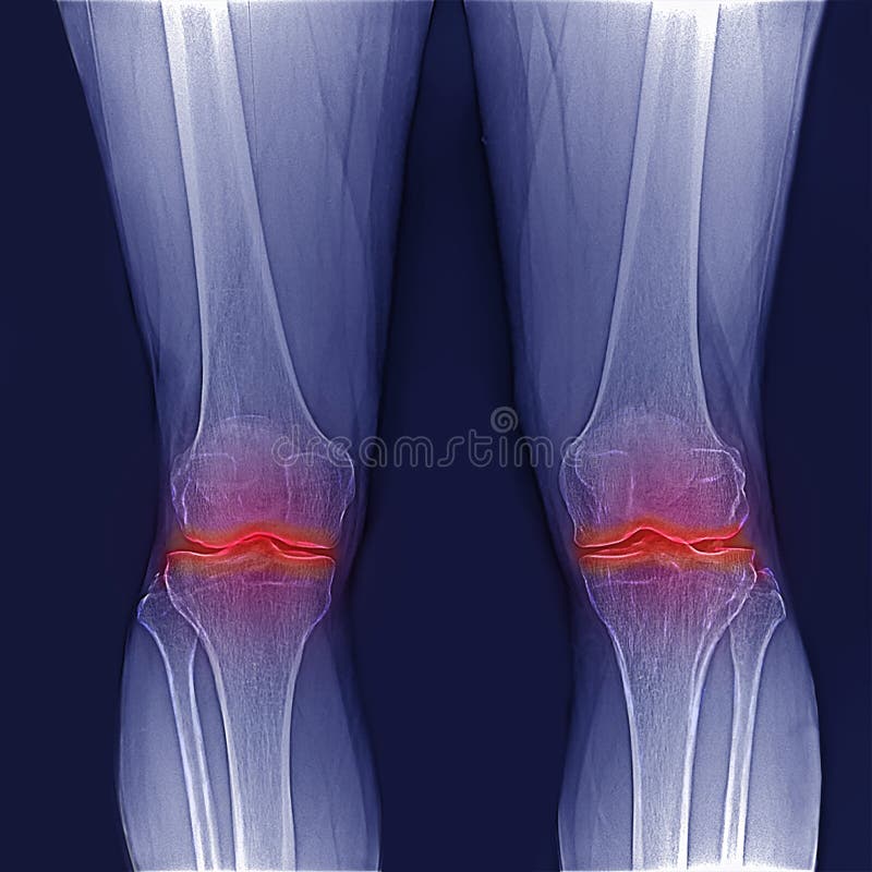 The X-ray Shows Arthrosis of the Human Knee Joints Stock Photo - Image ...