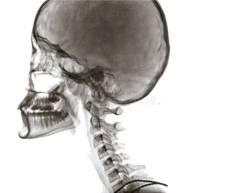 X Ray Skull Side