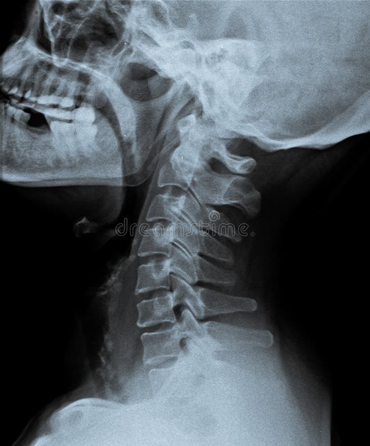 X Ray of Side View of Human Child Skull. Stock Photo - Image of imaging ...