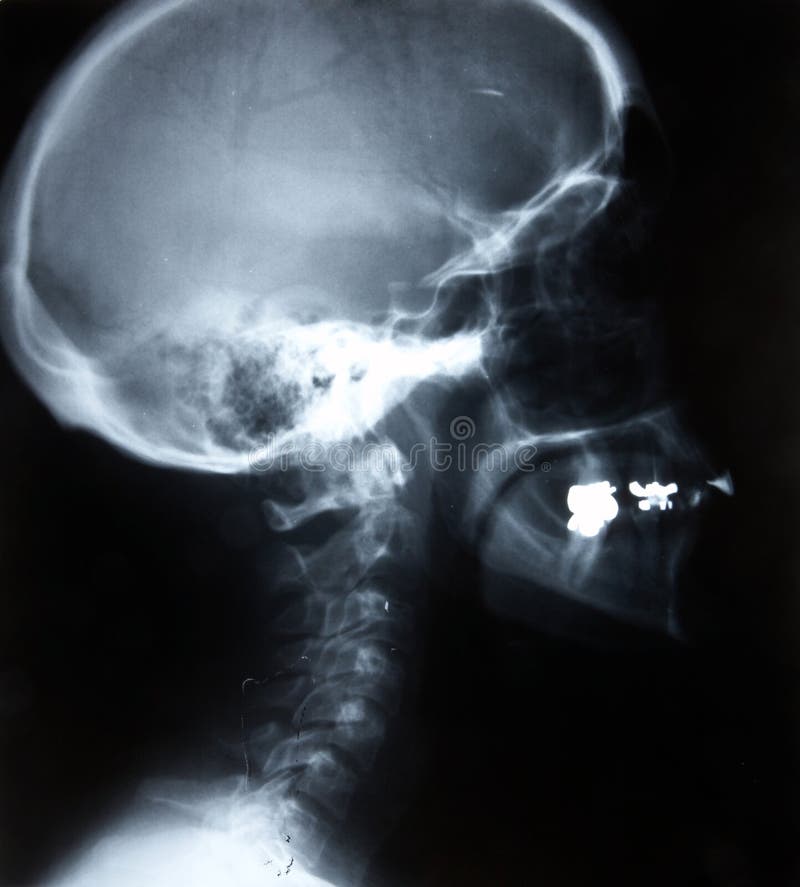 X-ray of skull stock photo. Image of background, care - 4954338