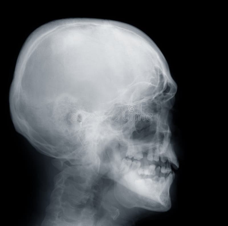 X-ray Skull stock photo. Image of view, exam, bone, side - 8594746
