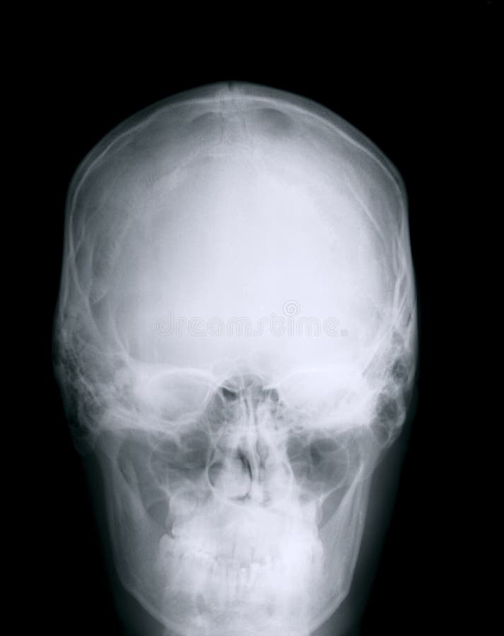 X-ray Skull stock image. Image of negative, skeleton, head - 8594771