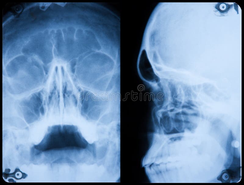X-Ray Skull Front and Side Profile Stock Image - Image of inside, high ...