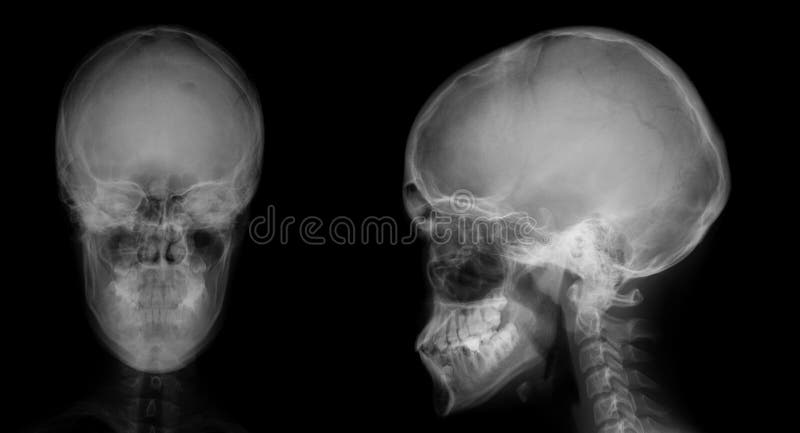 X-ray of the Skull. Osteoid-osteoma of the Frontal Sinus Stock Image ...