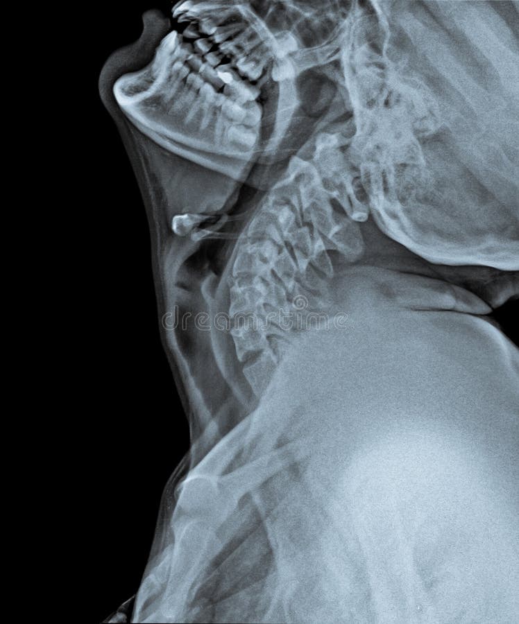 X Ray of Skull with Side of Neck. Stock Image - Image of prognosis ...