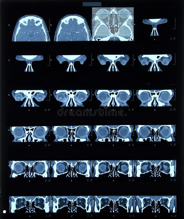 X-ray, Slice, CT of the Head, Skull Stock Photo - Image of health ...