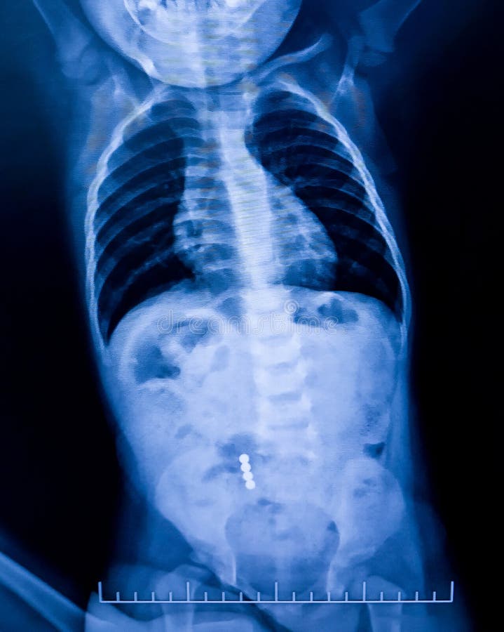 X-ray of a Small Child Who Swallowed 4 Round Magnets. Image of Magnets ...