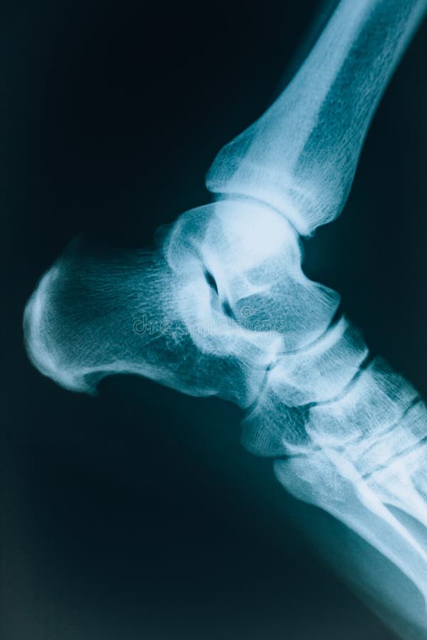 X-ray of the Foot. a Real X-ray Picture of a Sore Foot. at the Doctorâ ...