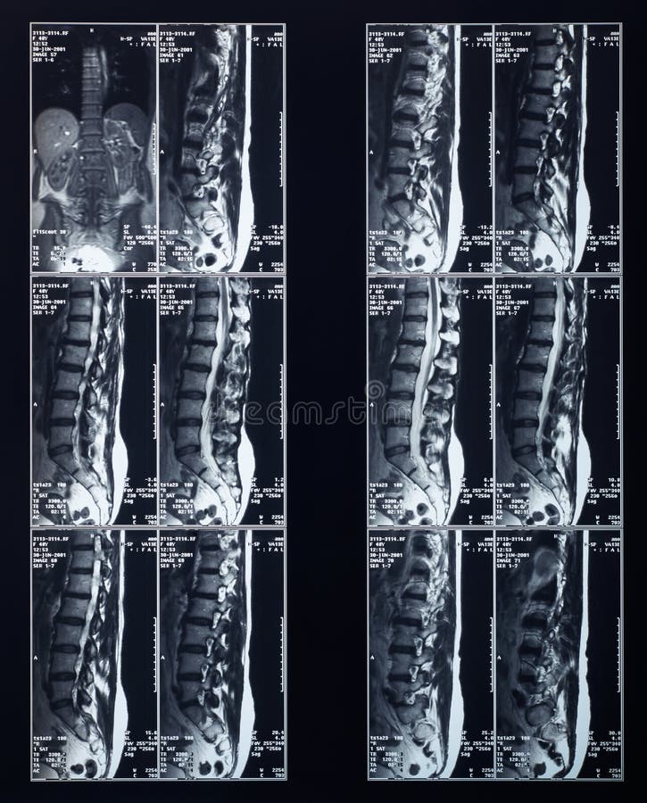X-ray spine radiography stock image. Image of trauma - 49173063