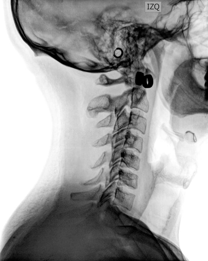 X-ray of the Spine and Skull Stock Illustration - Illustration of organ ...