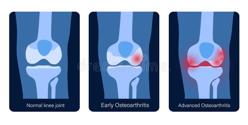 Knee Arthritis Stage Stock Illustrations 45 Knee Arthritis Stage Stock Illustrations Vectors
