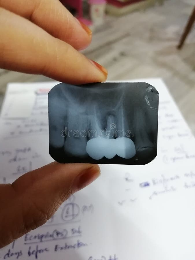 X-ray of teet stock photo. Image of iopa, infected, radiolucent - 173816042