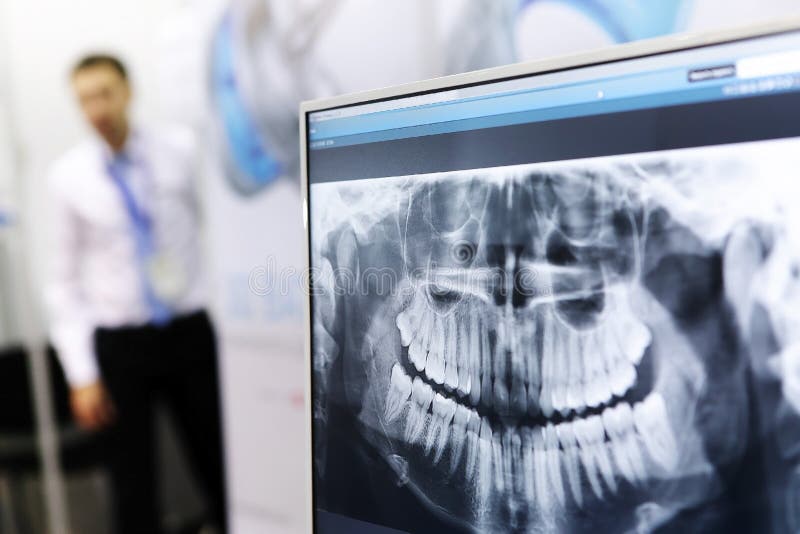 X-ray of Teeth on a Computer Monitor. Scanning the Human Jaw for ...