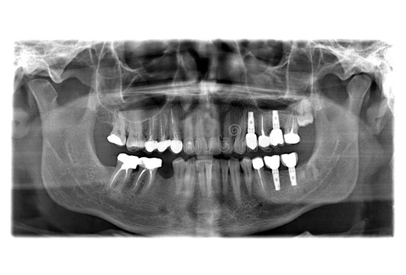 X ray of teeth stock image. Image of human, medicine - 141198959