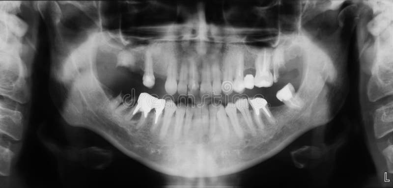 X-ray of teeth stock photo. Image of girl, hospital, procedure - 84067930