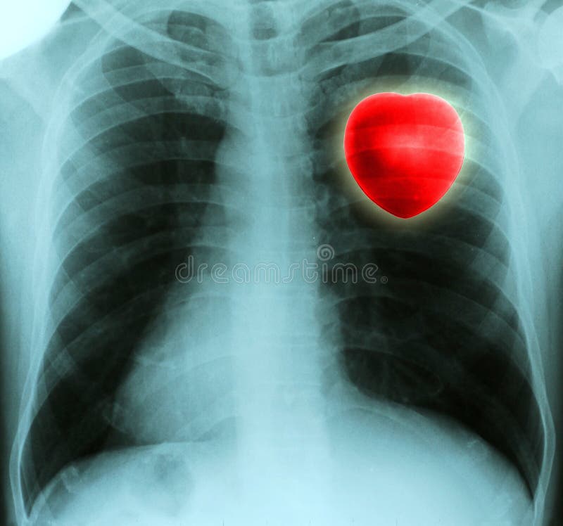 Thorax radiography stock image. Image of back, diagnoses - 25300429