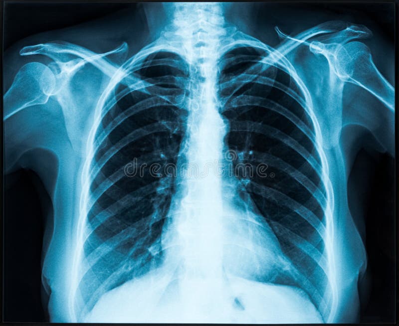 X-ray of thorax stock image. Image of anatomy, examination - 109052173