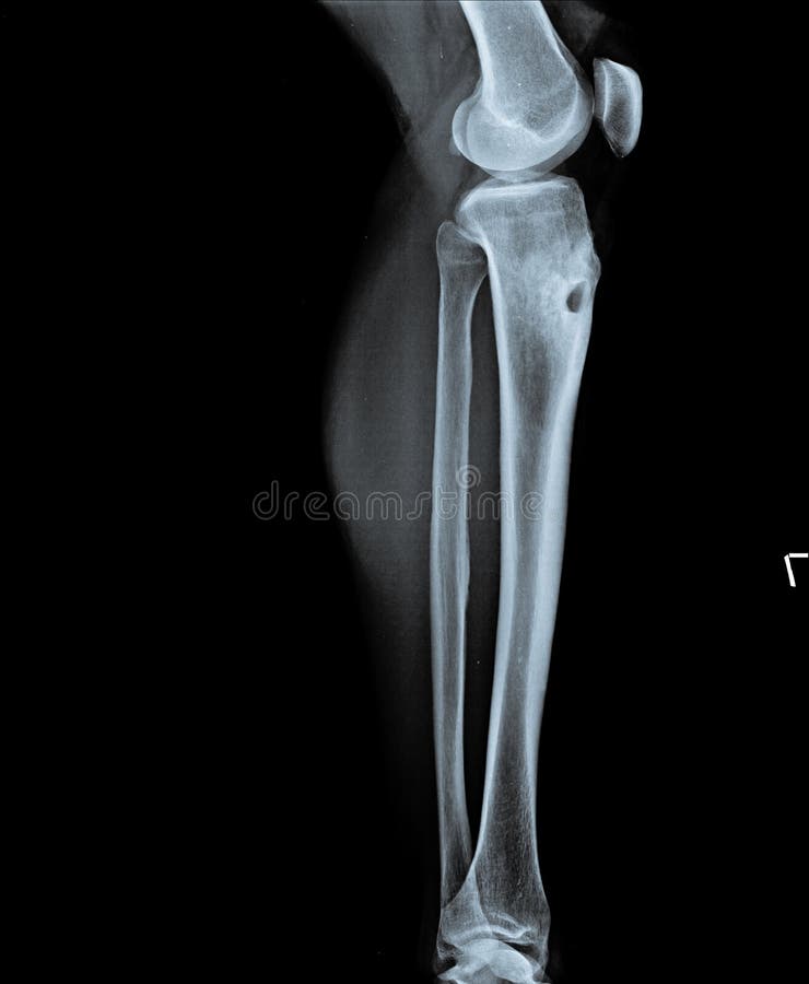 X Ray of Tibia with Infected Wound in Tibia Bone Stock Image - Image of ...
