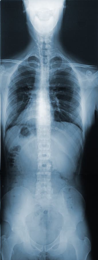 X-Ray of the Torso stock image. Image of neck, bones, orthopedics - 2234465