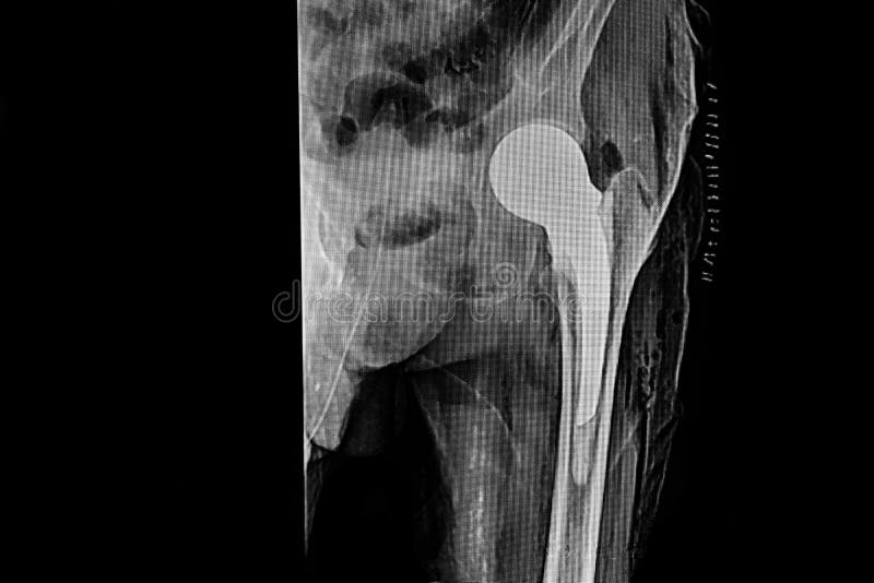 X- Ray of Total Hip Replacement Fracture Stock Image - Image of ...