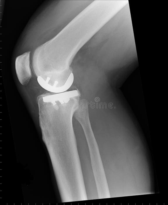 X Ray of a Unilateral Knee Replacement Stock Photo - Image of fibula ...