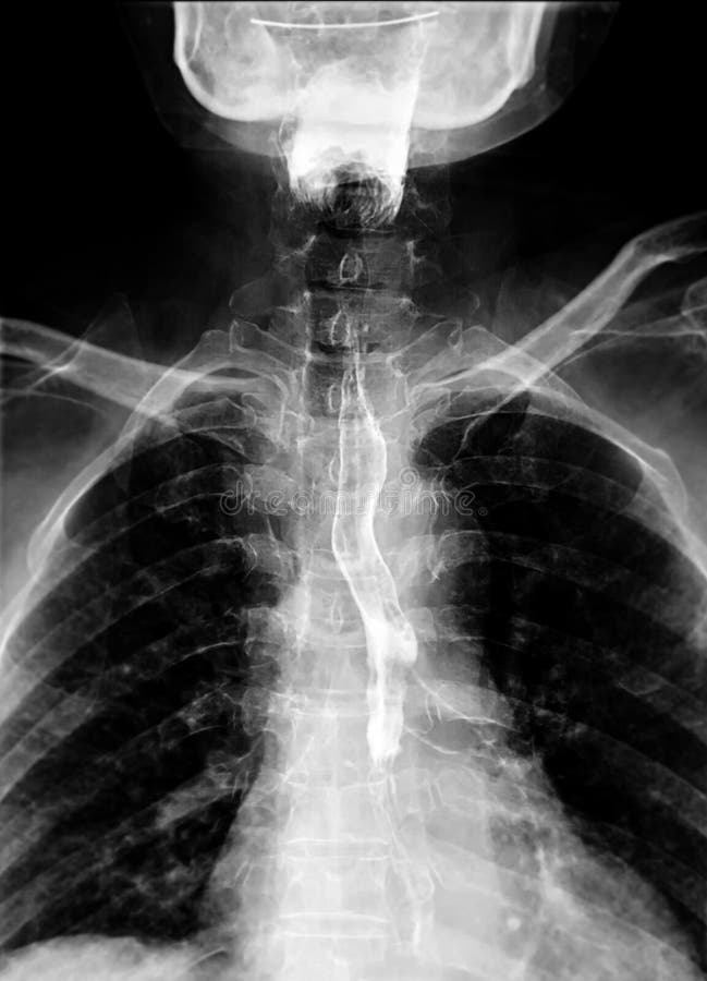 X-ray of the Upper Esophagus, Displaying Normal Swallowing Function ...