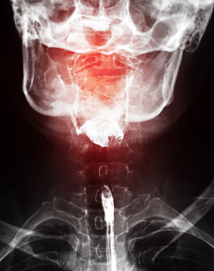 X-ray of the Upper Esophagus, Displaying Normal Swallowing Function ...