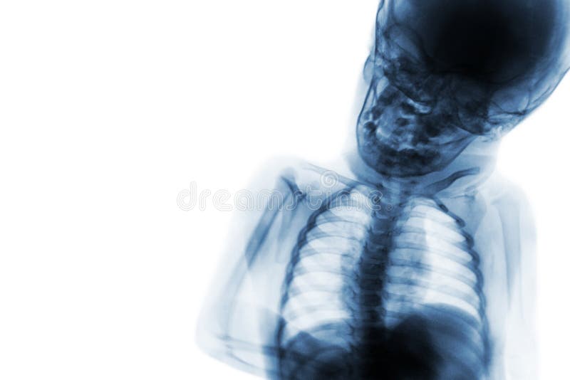 X Ray Body Child Blank Area Left Side Stock Photos - Free & Royalty ...