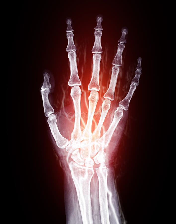 X-Ray and Vascular Imaging of Hand:.this Image Combines X-ray Bone ...