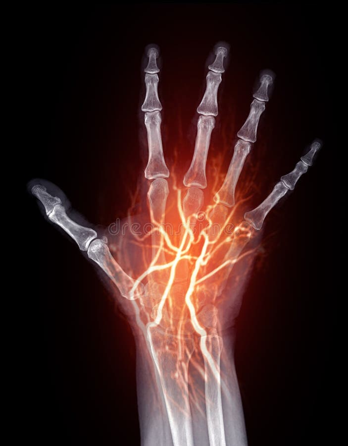 X-Ray and Vascular Imaging of Hand:.this Image Combines X-ray Bone ...
