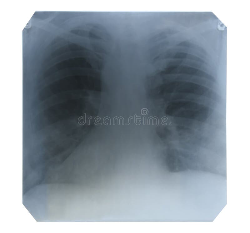 X-ray on white background stock photo. Image of radiation - 91974700