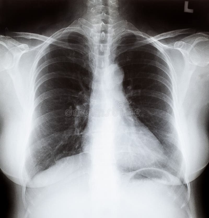 Women during Chest X Ray in Clinic Stock Image - Image of contemporary ...