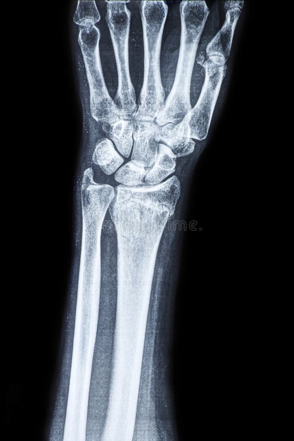 X-ray of the Wrist and Human Radius Stock Photo - Image of healthcare ...