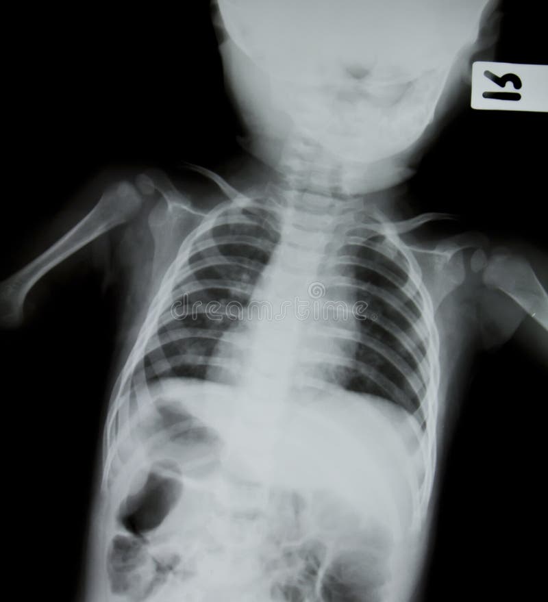 Chest x-ray of young boy. stock image. Image of children - 15762019