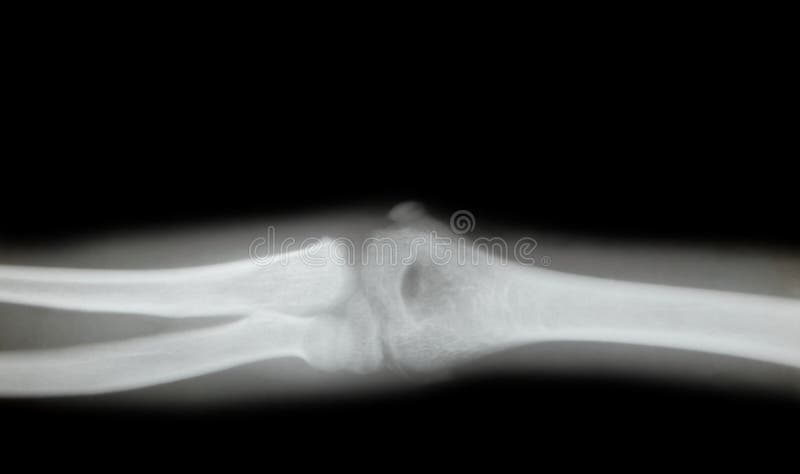 X-ray of a young mans arm stock image. Image of elbow - 21689973