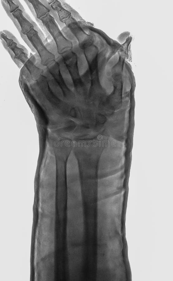 X-rayed Human Left Hand. X-ray of Hand Bones Stock Image - Image of ...