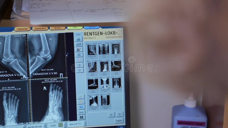 X-rays of the Foot and Knee on a Computer Screen Stock Video - Video of ...