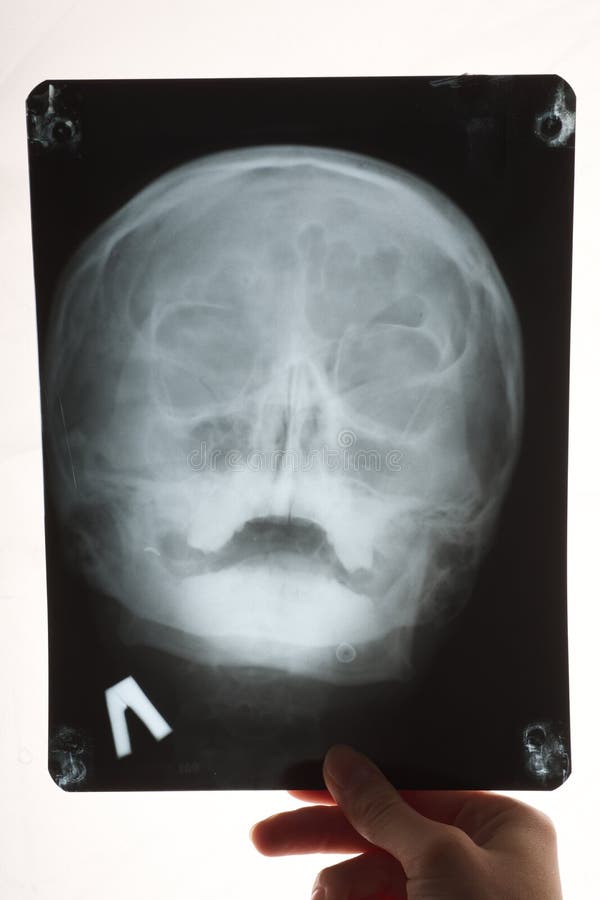 X-rays of the head stock photo. Image of disease, maxillitis - 24748398