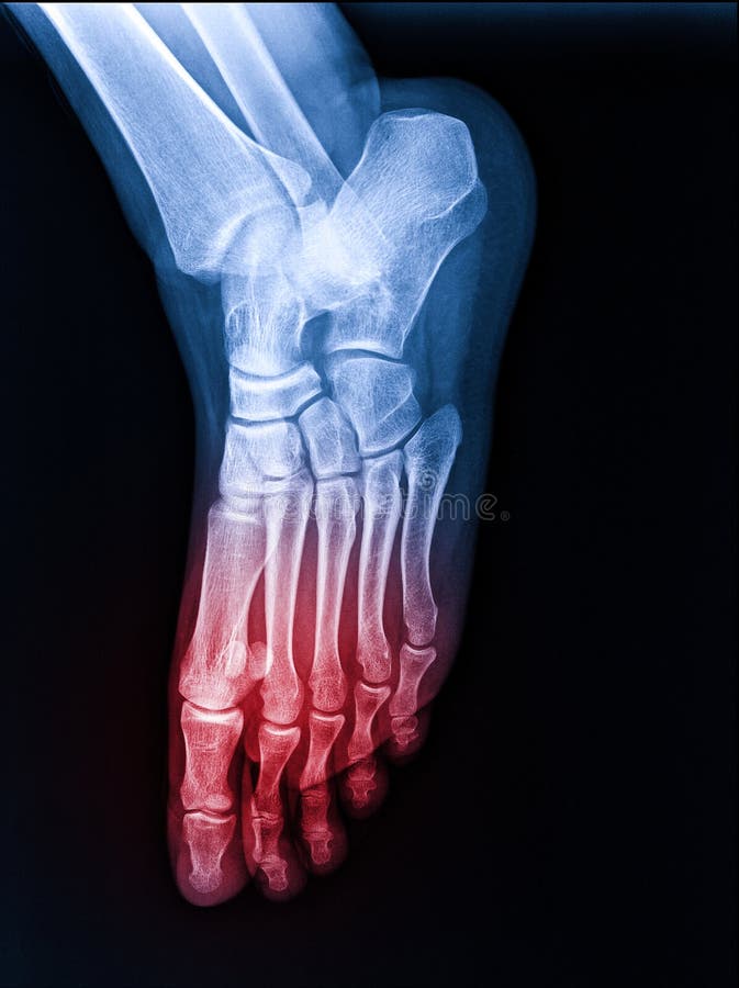 X-rays of the Human Foot, Highlighted in Red Stock Illustration ...