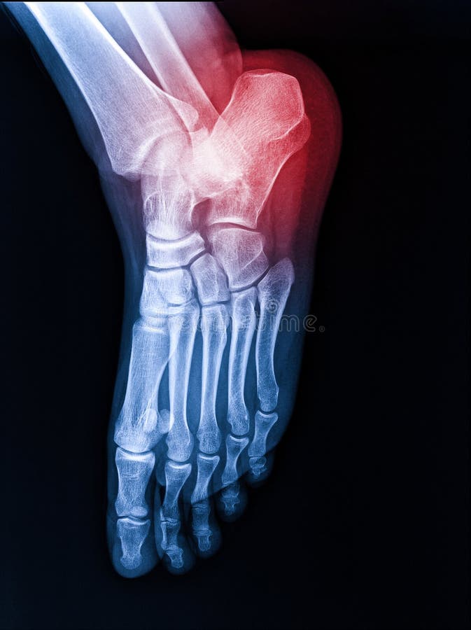 X-rays of the Human Foot, Highlighted in Red Stock Image - Image of ...